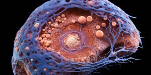 Glejak wielopostaciowy 4 stopnia: wyjaśnienie, diagnoza i leczenie ...